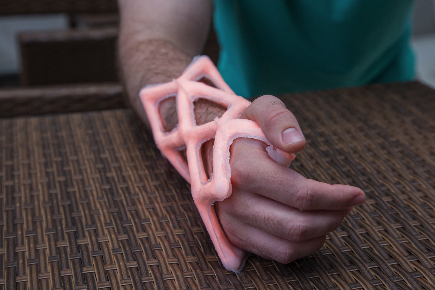 Smart Cast Will Make Breaking Your Arm Suck a Bit Less | Digital Trends
